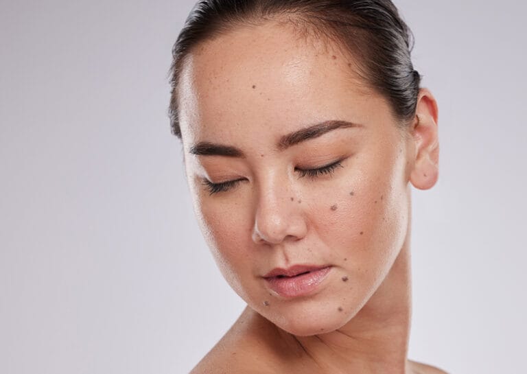Cosmetic Skin Tag And Mole Removal - Ottawa Institute of Plastic Surgery